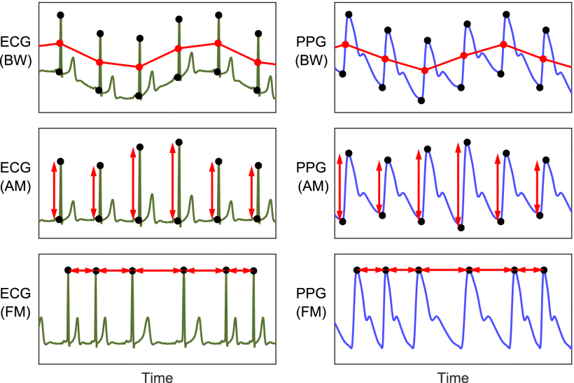Breathing rate estimation from the electrocardiogram and photoplethysmogram: a review | Peter ...